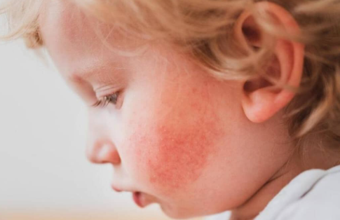 What's Behind the Quick Spread of the 'Slapped Cheek' Virus in the U.S ...